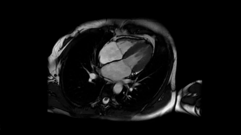 Resonancia cardíaca: ¿qué es? - Origen, Diagnóstico y traumatología