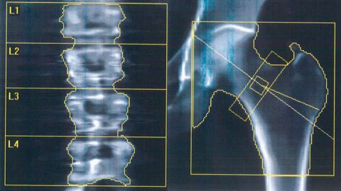 Densitometría Ósea: osteoporosis - Origen, Diagnóstico y traumatología