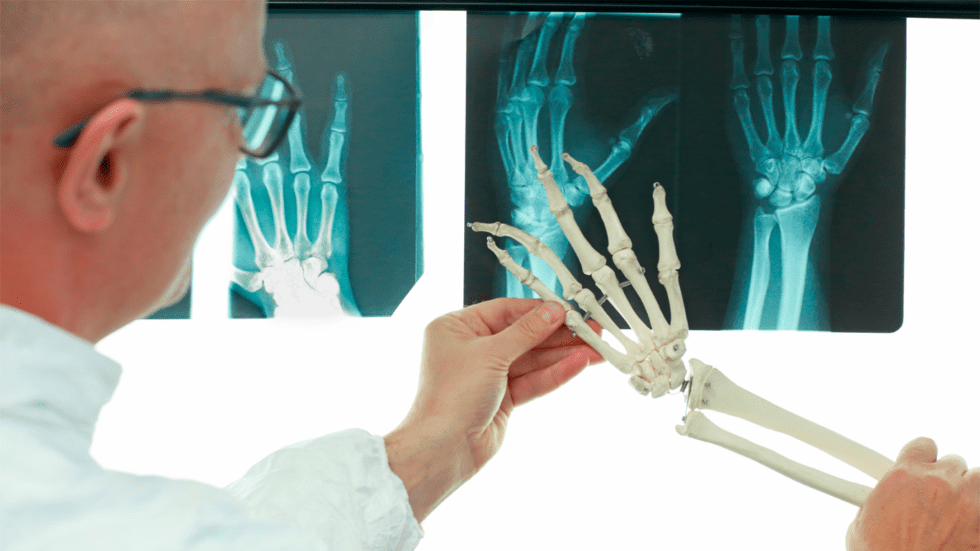 Hipoplasia del cúbito: condición que afecta la función del antebrazo y ...